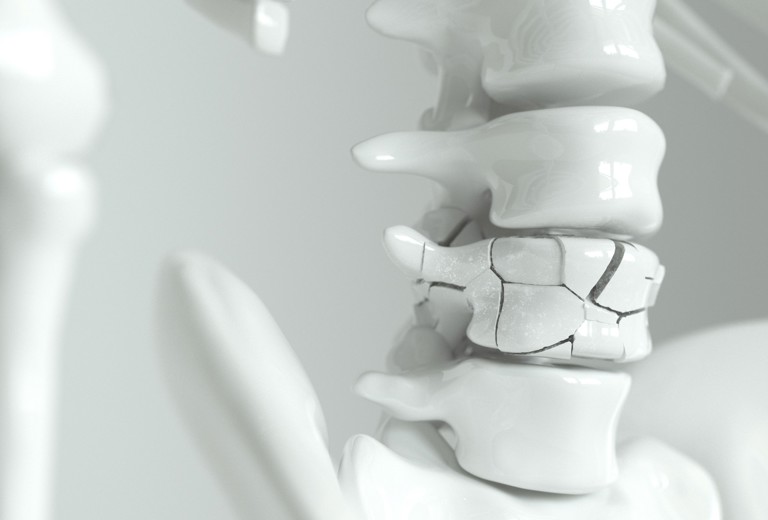 Osteoporose - Symptome & Diagnostik | Bioscientia | Labordiagnostik